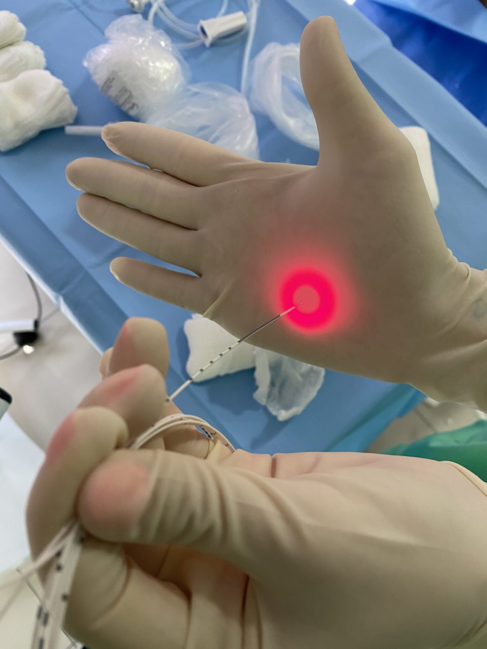 Laser e tratamento de Varizes | MEDVASC